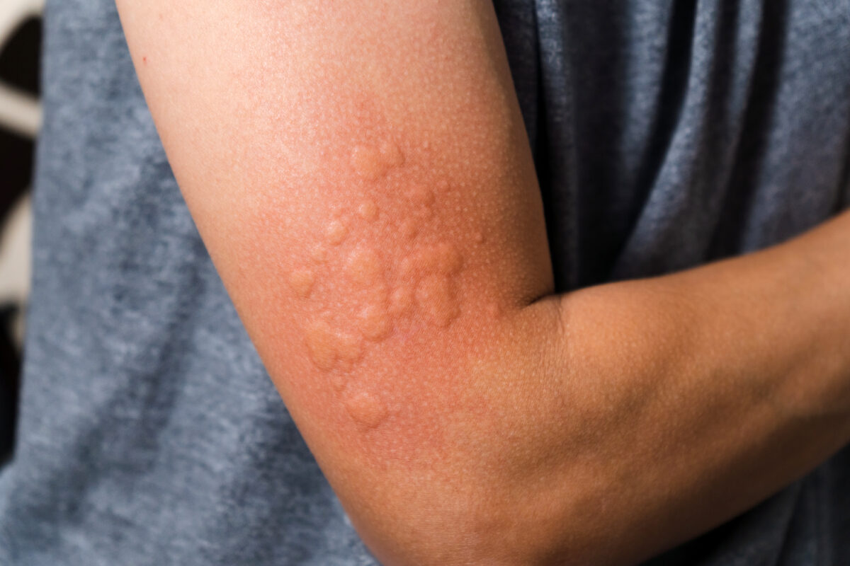 Latex Allergy - Recognize and Identify an Allergic Reaction