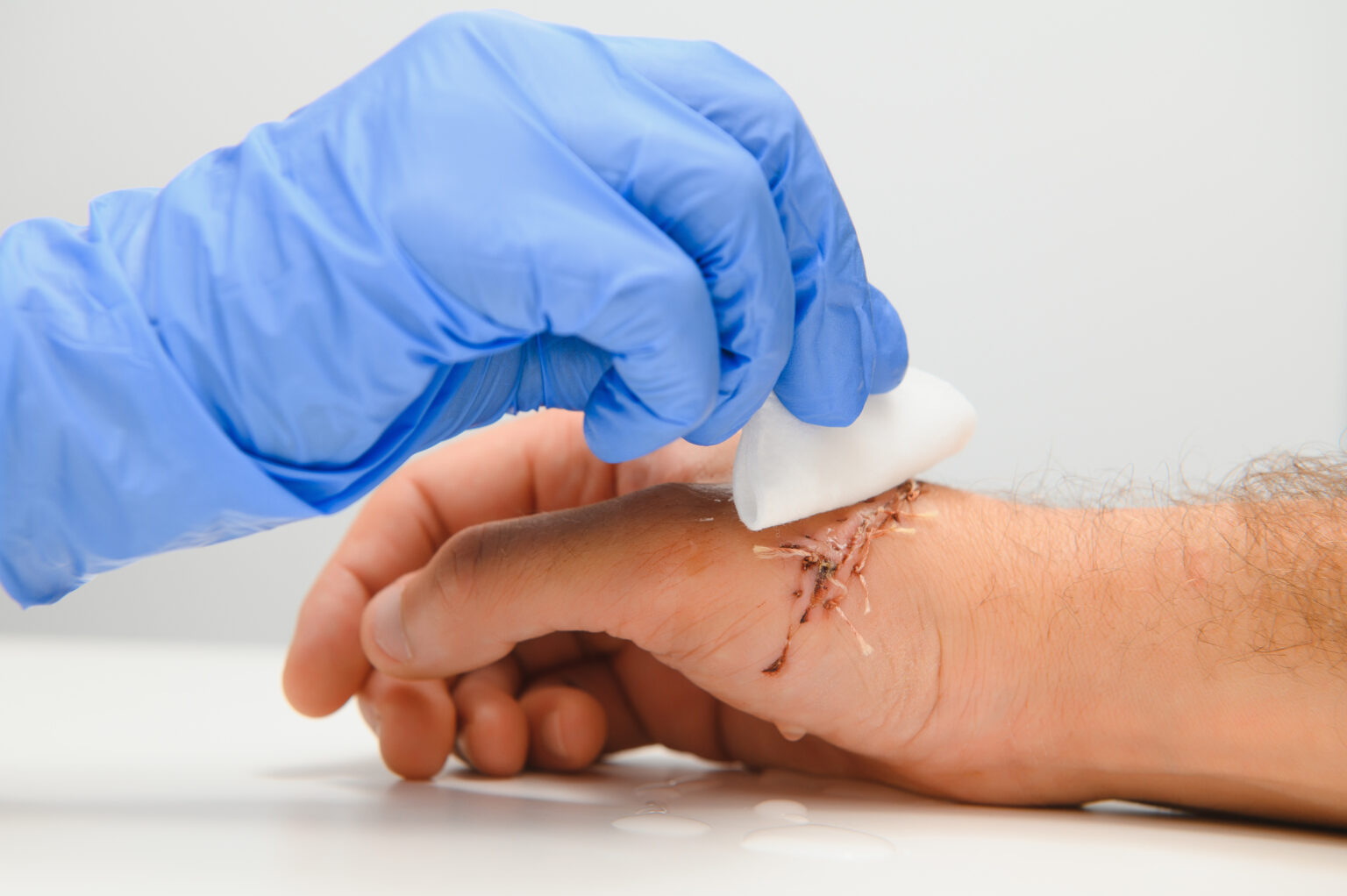 Moist Wound Healing: A Superior Approach for Optimal Recovery